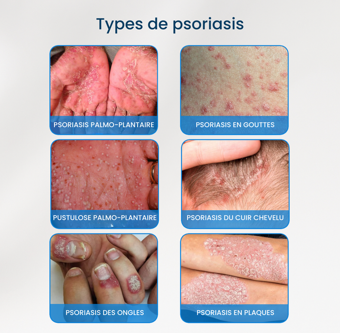 Dermora – Crème naturelle dermatite séborrhéique & psoriasis